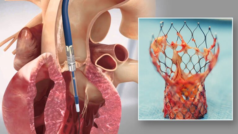 TAVI Expert in Jaipur - TAVI Doctor Jaipur | Transcatheter Aortic Valve ...