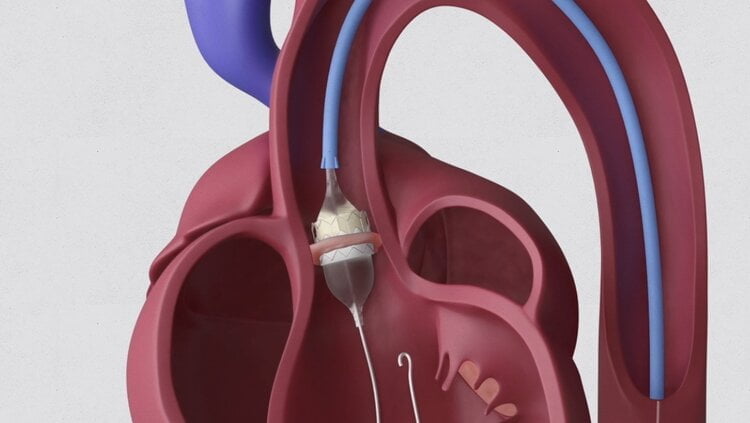 TAVI Expert in Jaipur - TAVI Doctor Jaipur | Transcatheter Aortic Valve ...